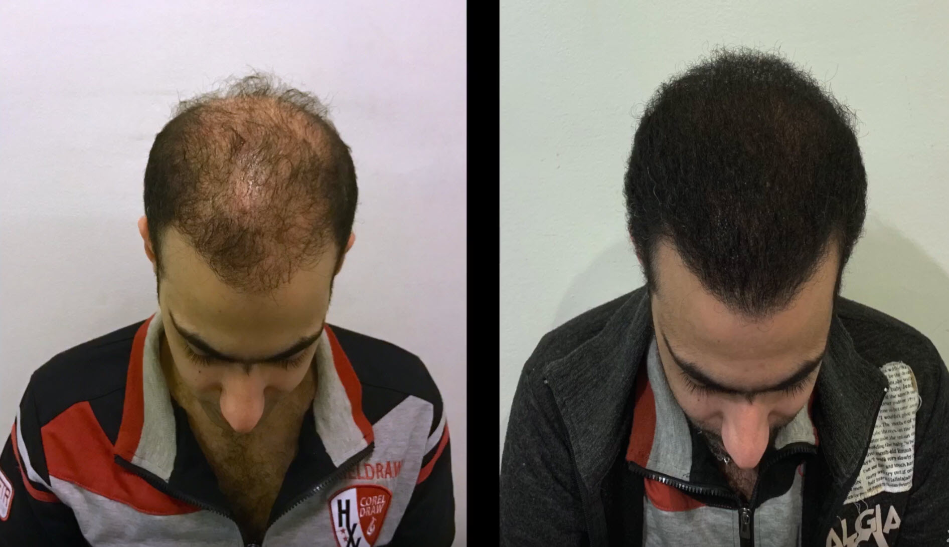Patient Shares Story Of Bad Hair Transplant In Turkey Fight The Fight